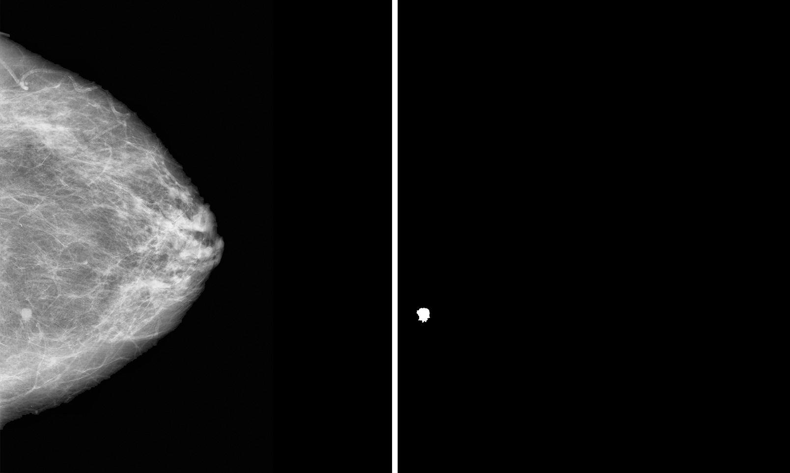 AI on mammogram - MiNNOVAA